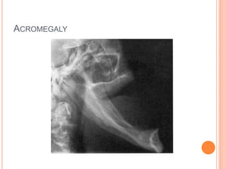 SYSTEMIC DISEASES OF BONE.pptx
