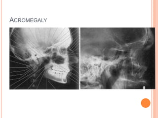 SYSTEMIC DISEASES OF BONE.pptx
