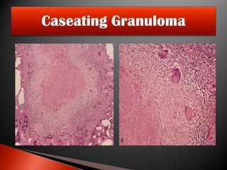 Systemic effects of acute inflammation and granuloma | PPTX