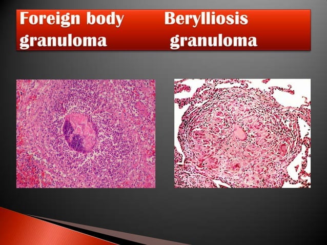 Systemic effects of acute inflammation and granuloma | PPTX | Blood ...