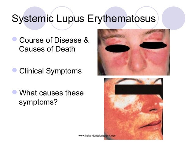 Systemic lupus /certified fixed orthodontic courses by Indian dental