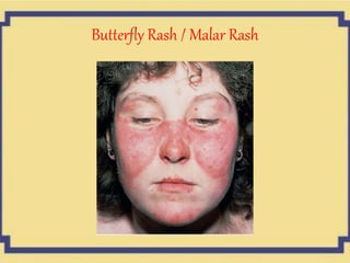 Systemic lupus | PPTX | Blood Disorders | Diseases and Conditions