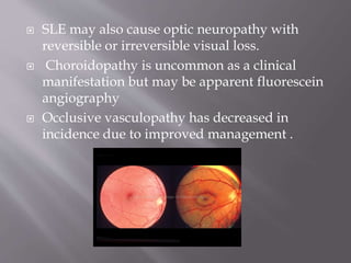 Systemic lupus erthematosus (sle) [autosaved] | PPT