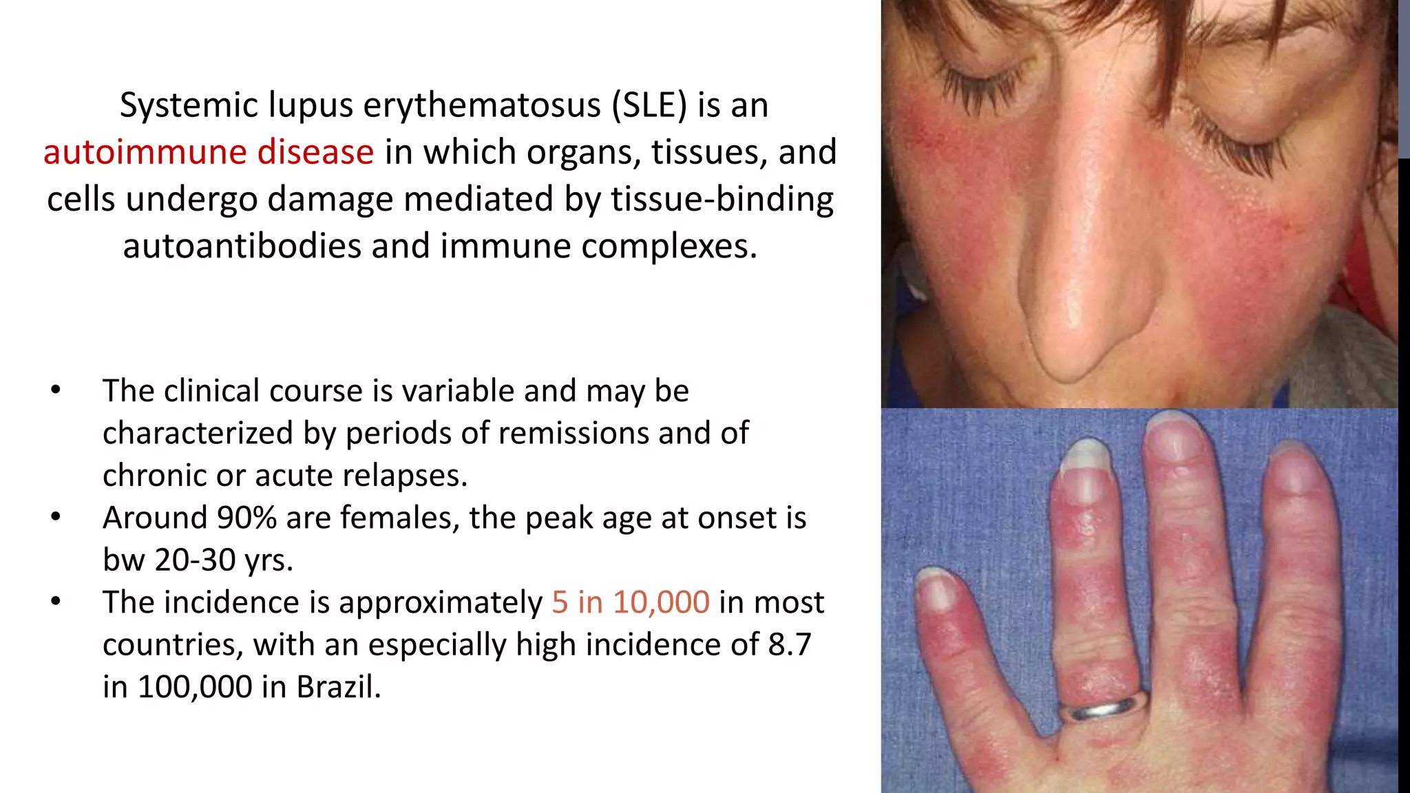 Systemic lupus erythematosis | PPTX
