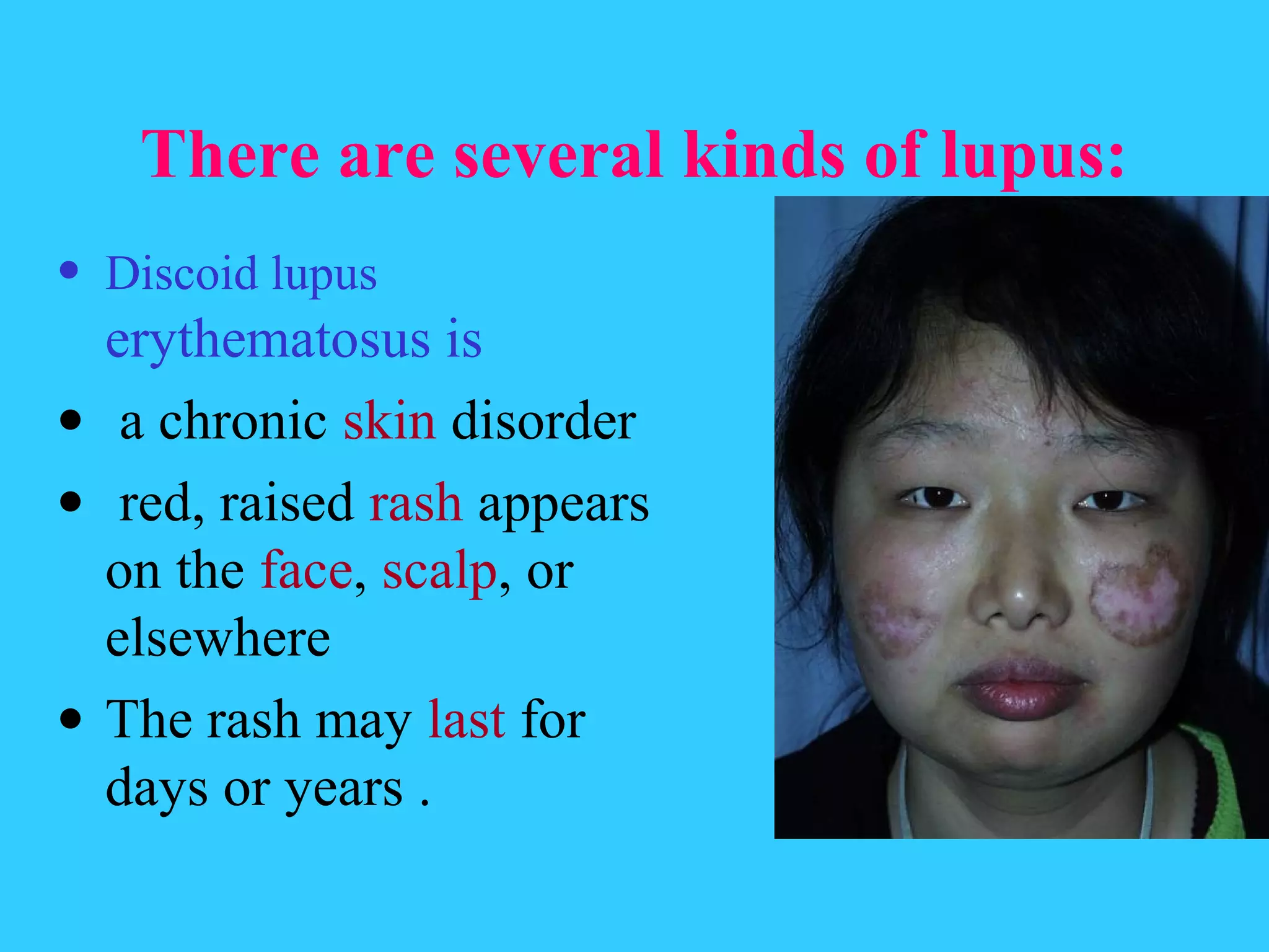 Systemic lupus erythematosus | PPT