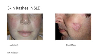 Systemic lupus erythematosus | PPTX