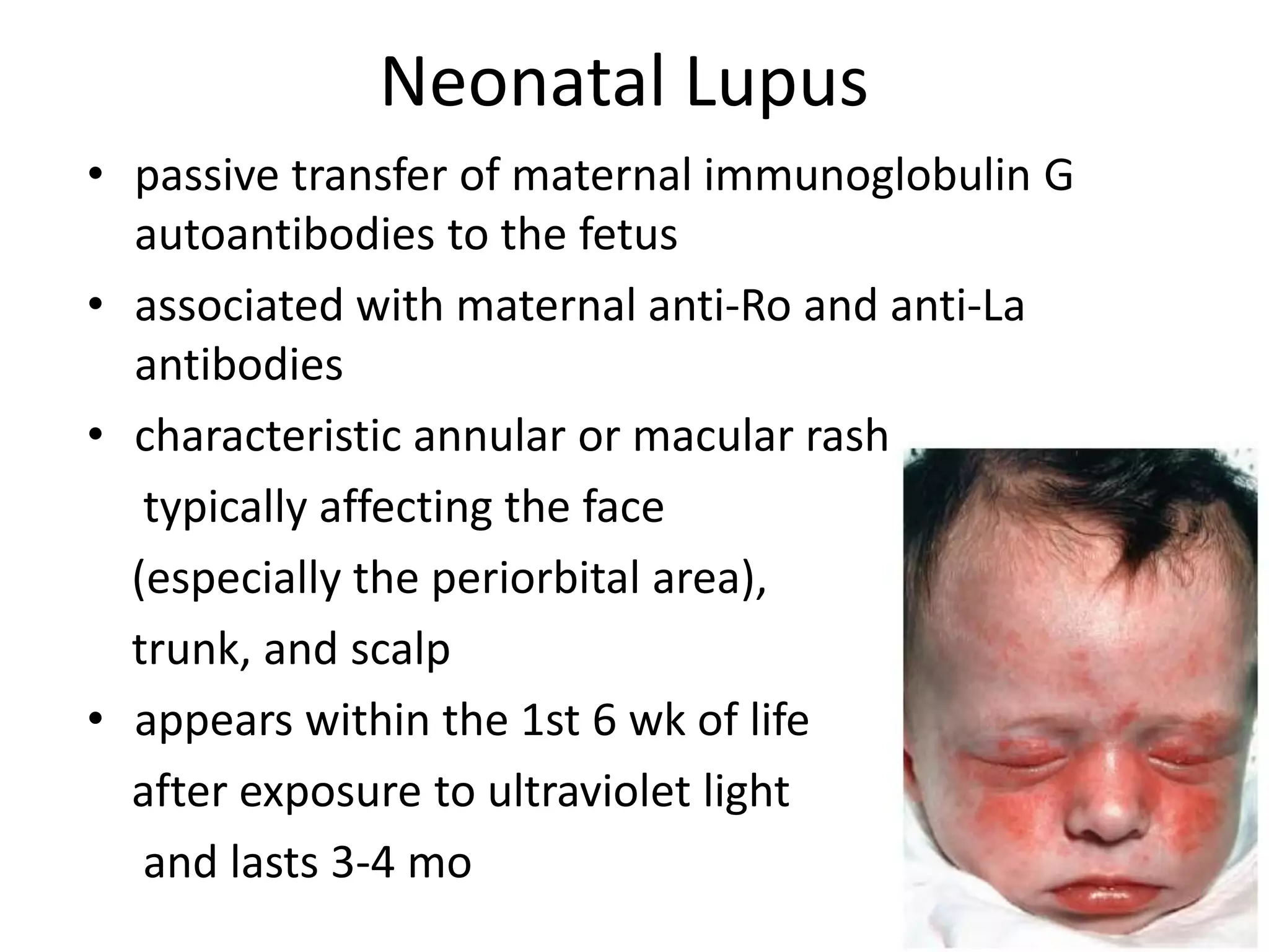 pediatric Systemic lupus erythematosus | PPTX