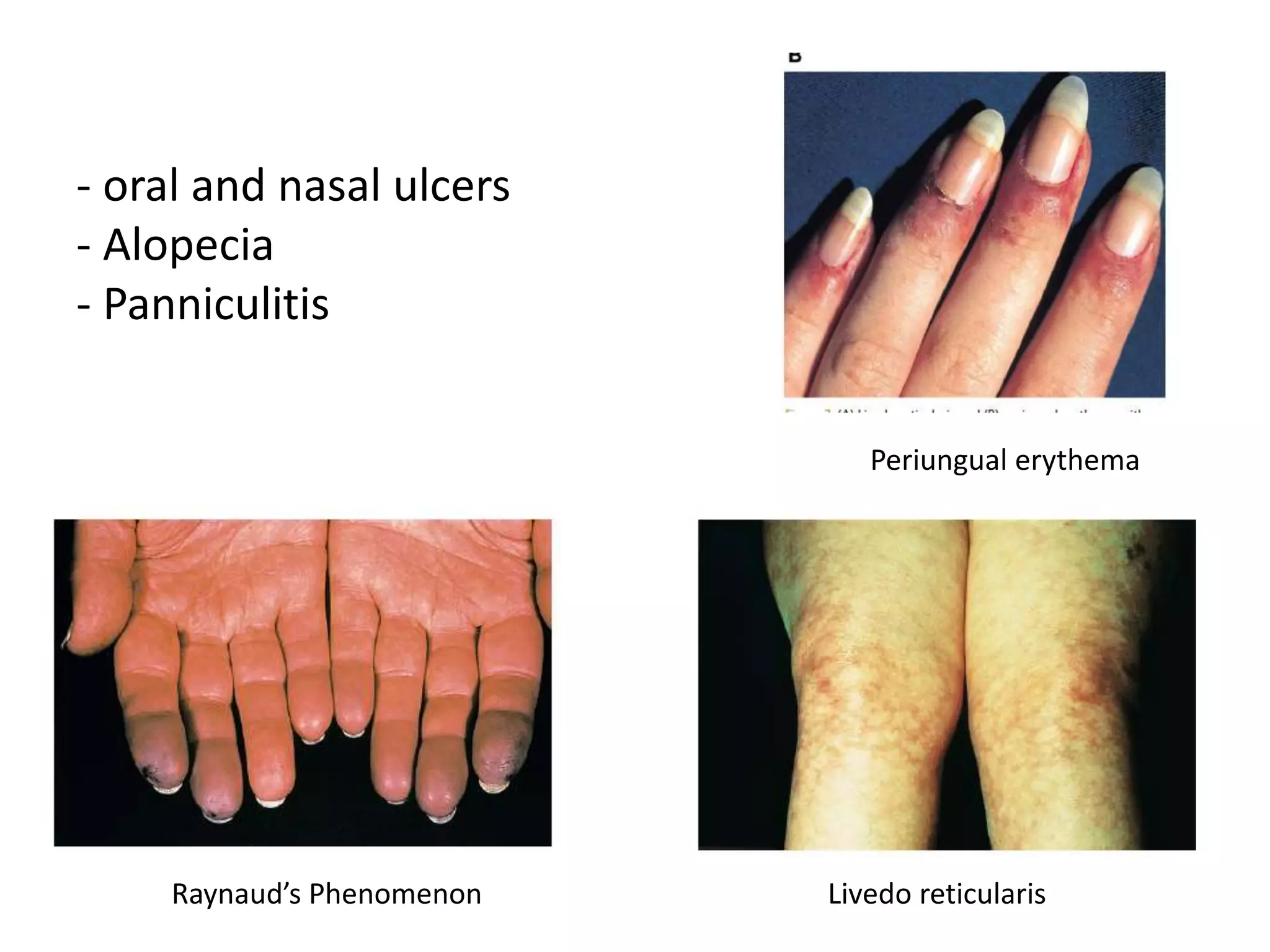 pediatric Systemic lupus erythematosus | PPTX