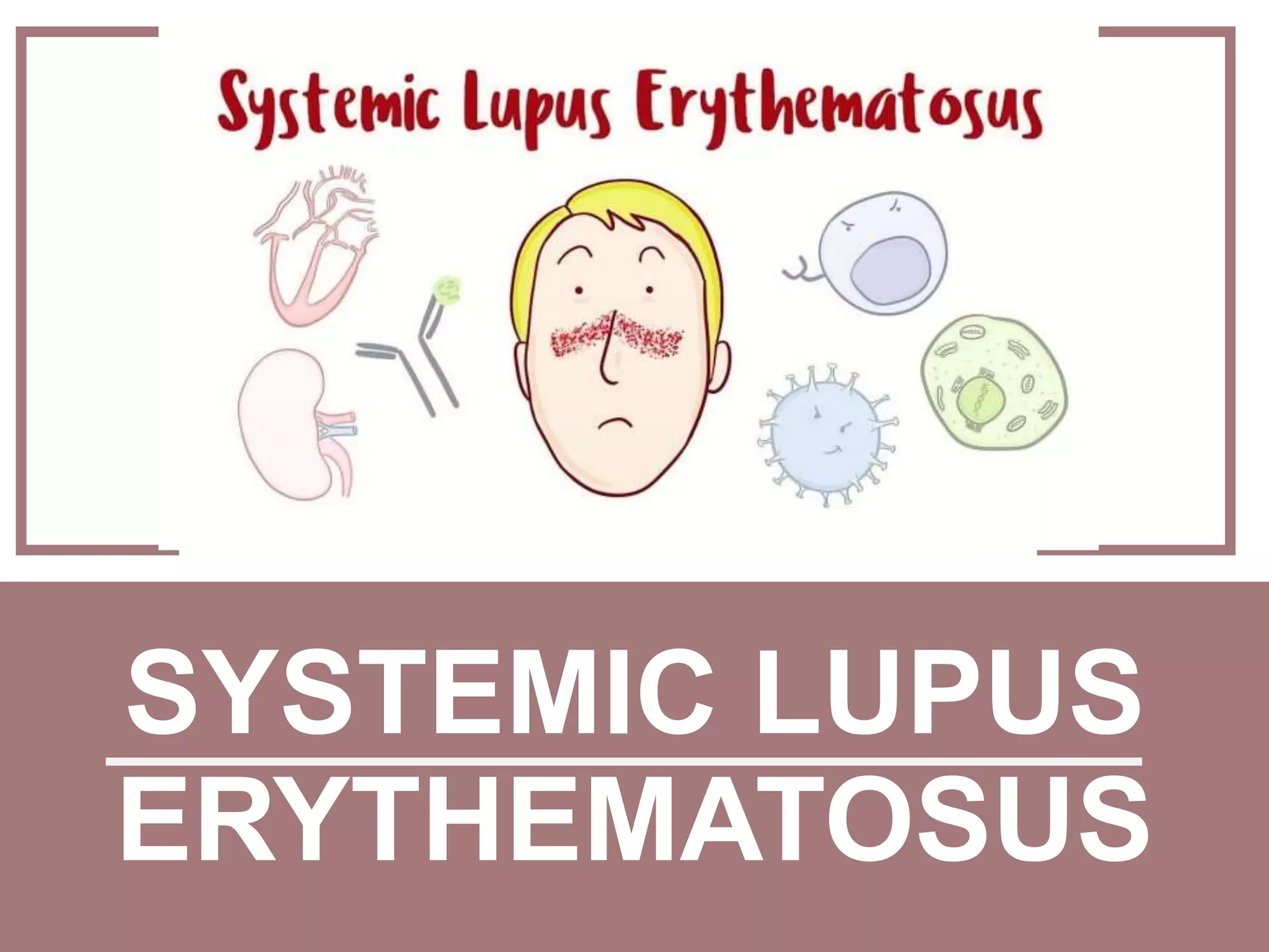 Systemic lupus erythematosus (SLE) | PPTX