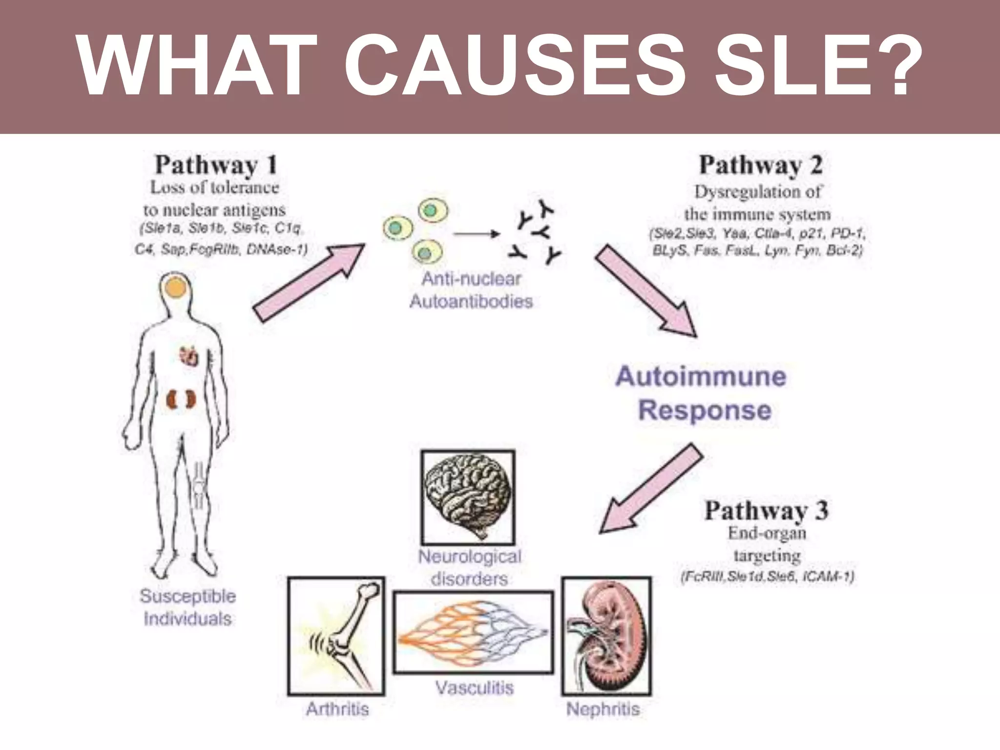 Systemic lupus erythematosus (SLE) | PPTX