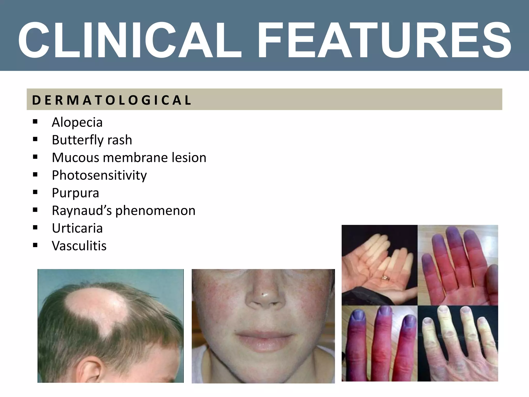 Systemic lupus erythematosus (SLE) | PPTX