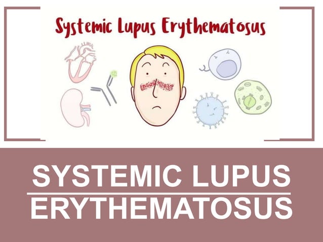 Systemic lupus erythematosus (SLE) | PPTX