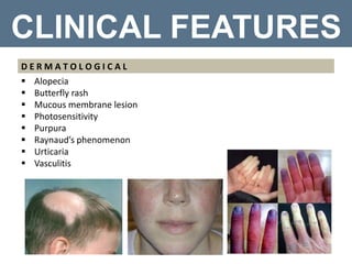 Systemic lupus erythematosus (SLE) | PPTX