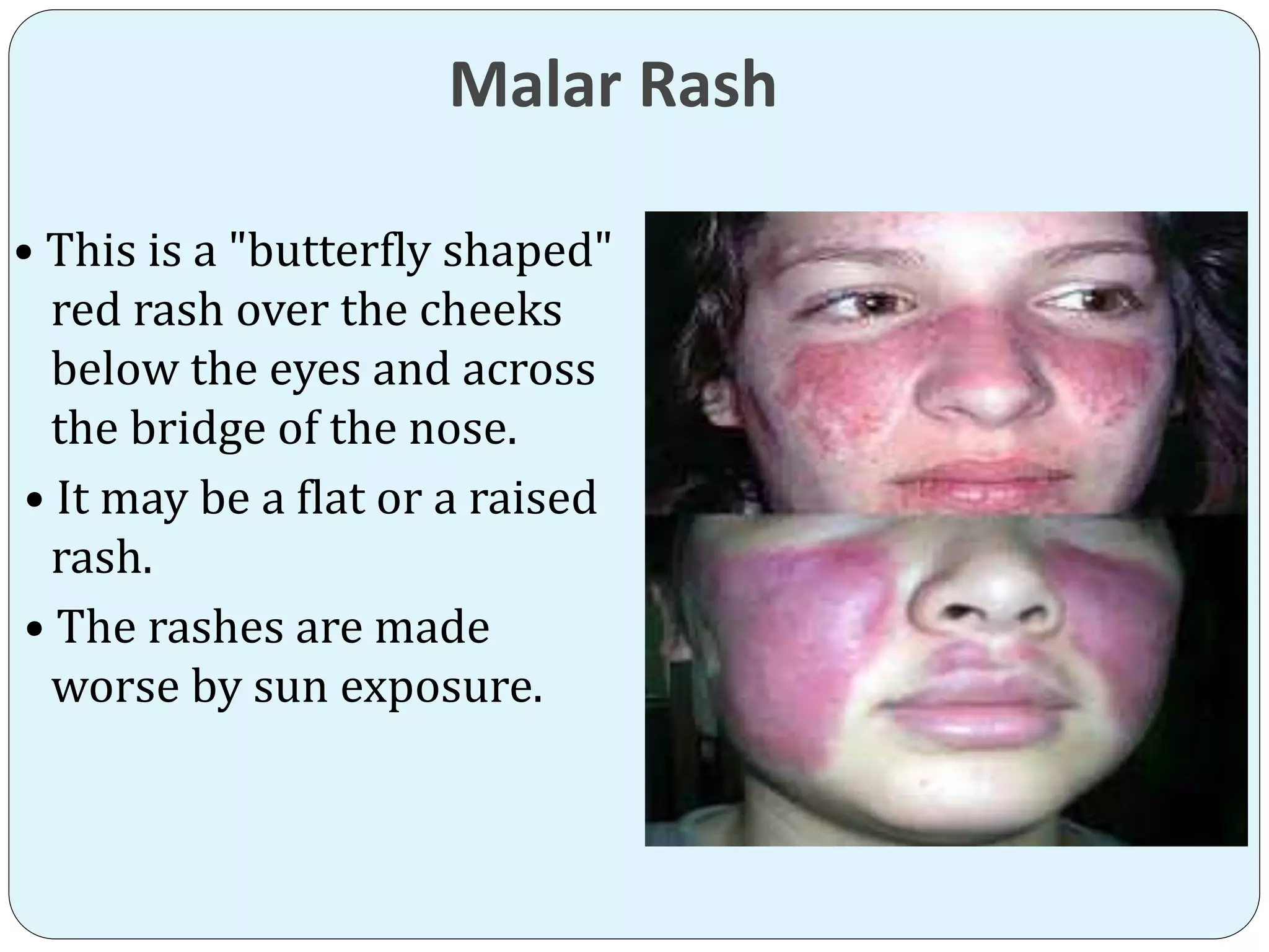 Systemic lupus erythematosus | PPTX