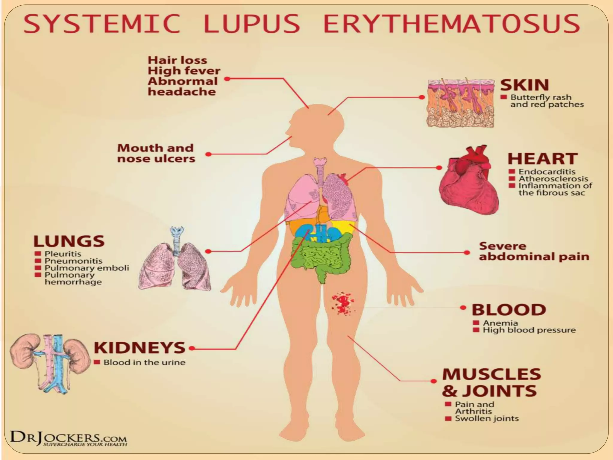 Systemic lupus erythematosus | PPTX