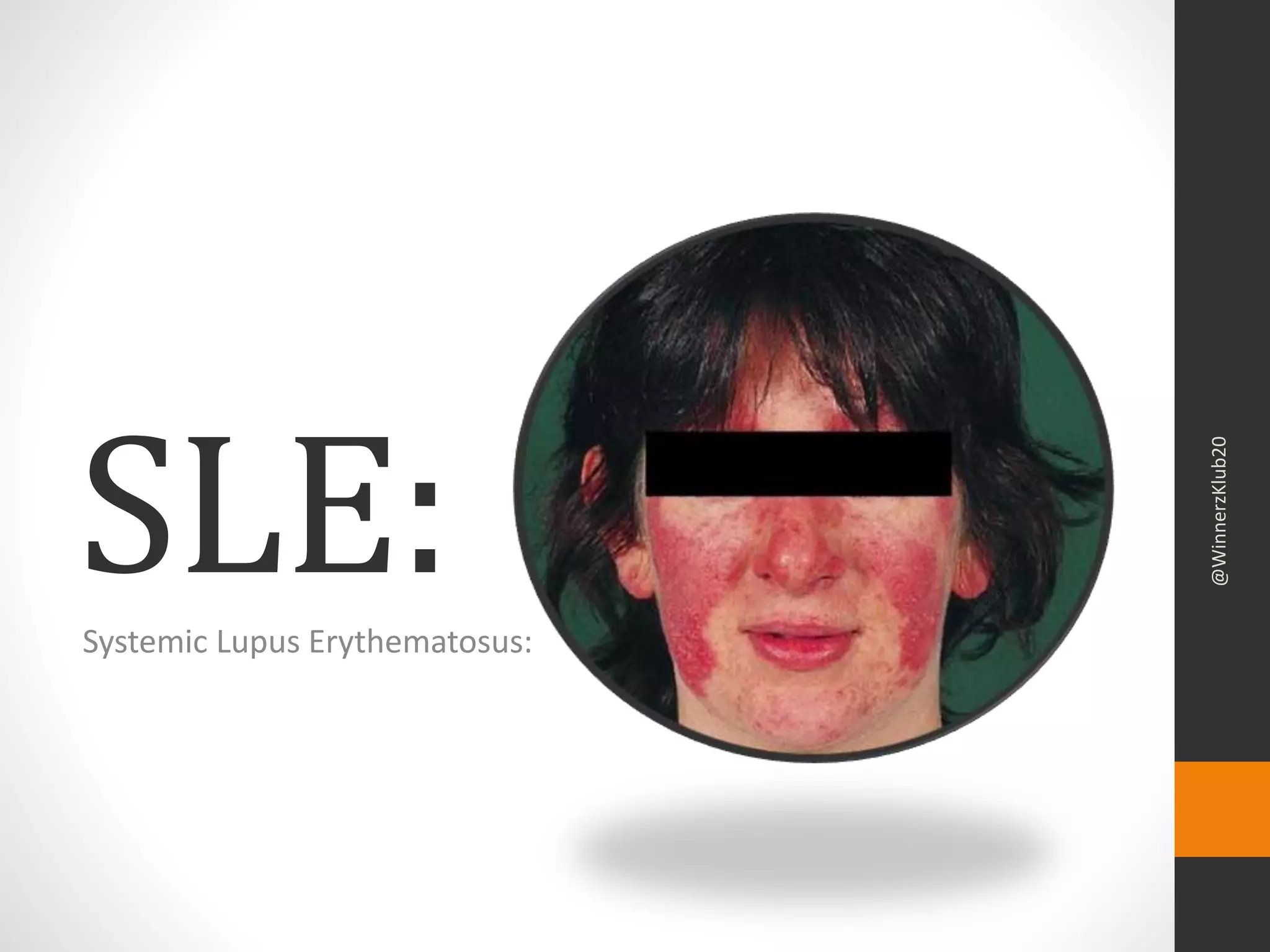 Systemic lupus erythematosus | PPTX