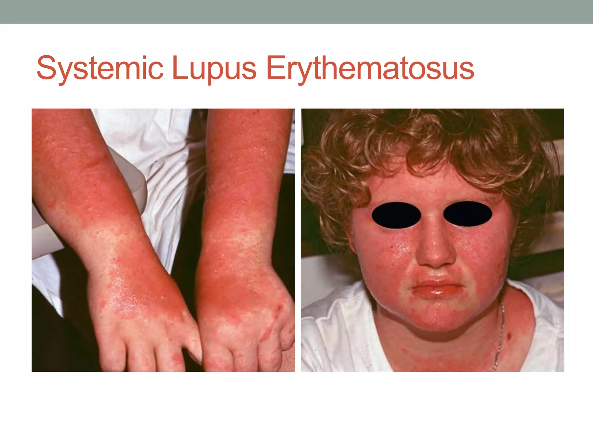 Systemic lupus erythematosus | PPTX