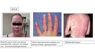 Systemic lupus erythematosus.pptx