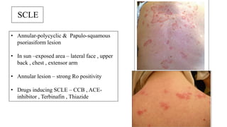 Systemic lupus erythematosus.pptx