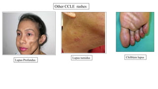 Systemic lupus erythematosus.pptx