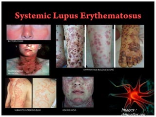 Systemic lupus erythematosus | PPT