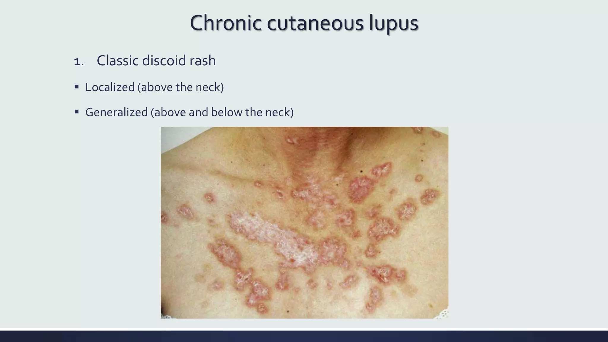 Systemic lupus erythematosus | PPTX