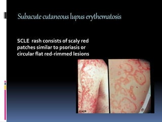 Systemic lupus erythematosus | PPT