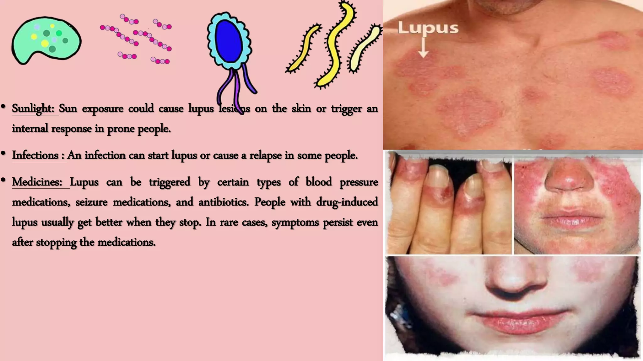 Systemic lupus erythematosus | PPTX