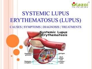 Systemic lupus erythematosus (lupus): Disease of the immune system | PPTX