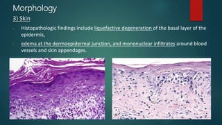 Systemic lupus erythematosus - Dr Pranav | PPTX