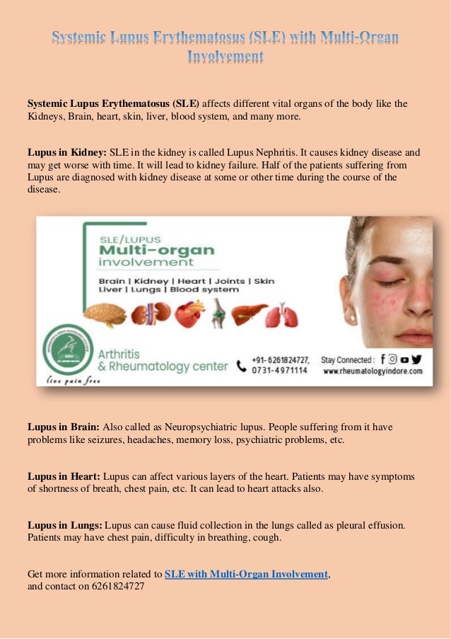 Systemic lupus erythematosus (sle) with multi organ involvement - Dr ...