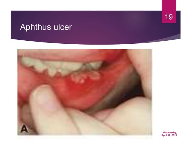 systemic manifestations of IBD.ppt | Digestive Disorders | Diseases and ...