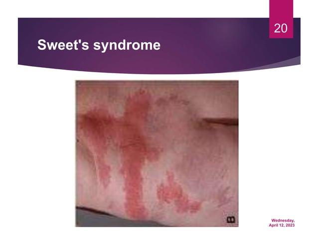 systemic manifestations of IBD.ppt | Digestive Disorders | Diseases and ...