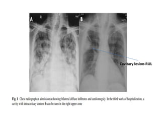 Systemic mucormycosis | PPTX