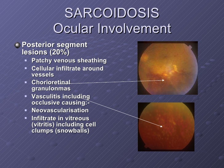 Ocular Involvement In Sarcoidosis Cmaj
