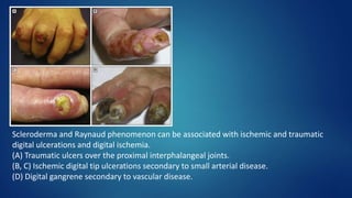 Systemic sclerosis-1.pptx | Free Download