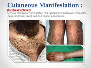 Systemic sclerosis - maha hammmady | PPTX