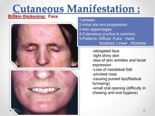 Systemic Scleroderma Face