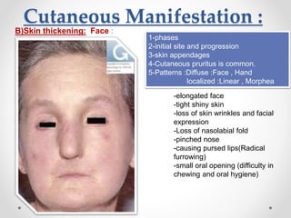 Systemic Scleroderma Face