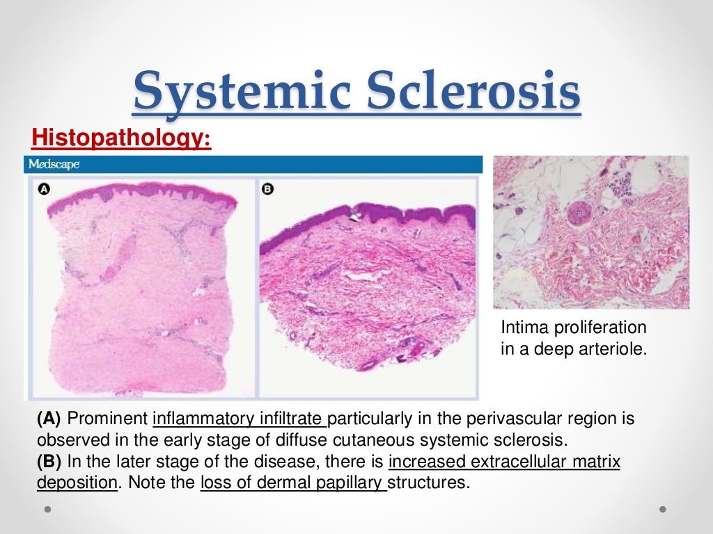 Systemic sclerosis
