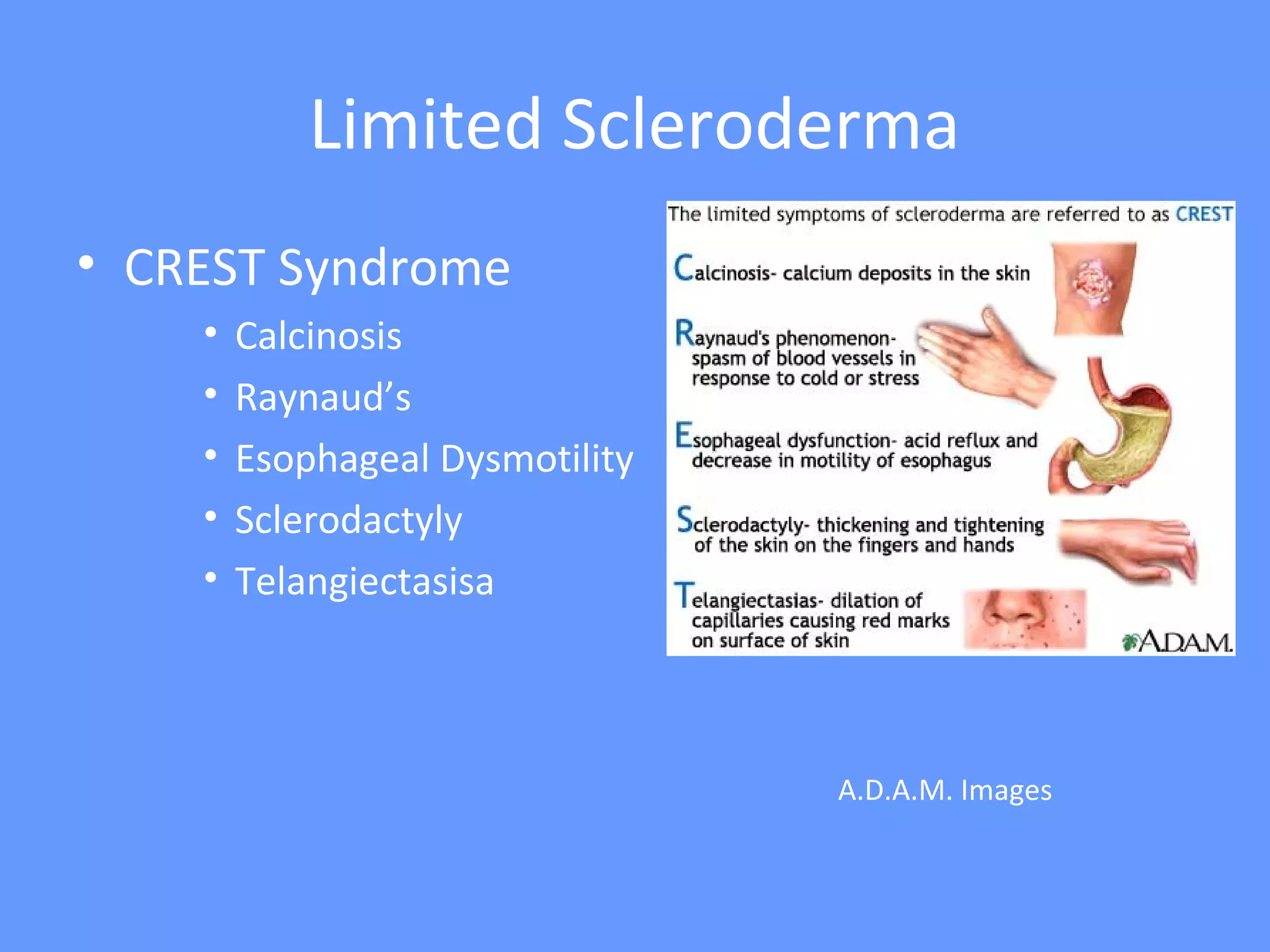 Systemic sclerosis | PPT