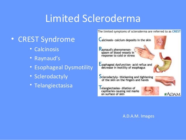 Systemic sclerosis