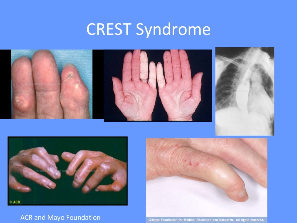 Systemic sclerosis