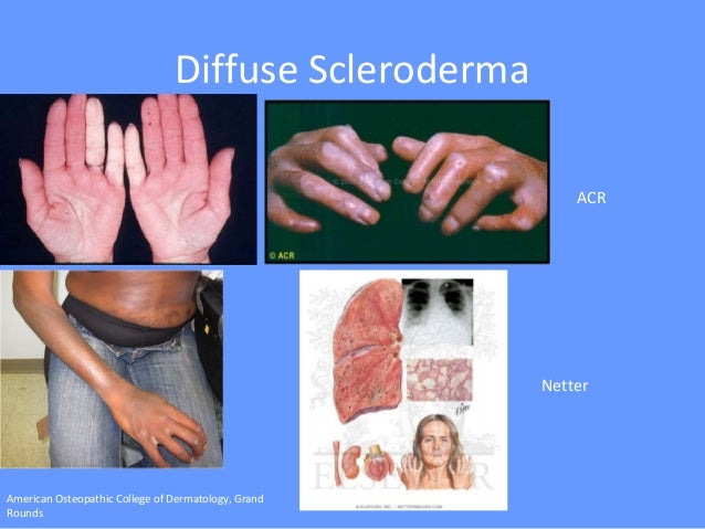 Systemic sclerosis