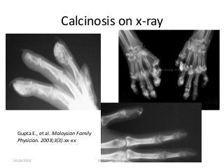 Scleroderma Hands Xray