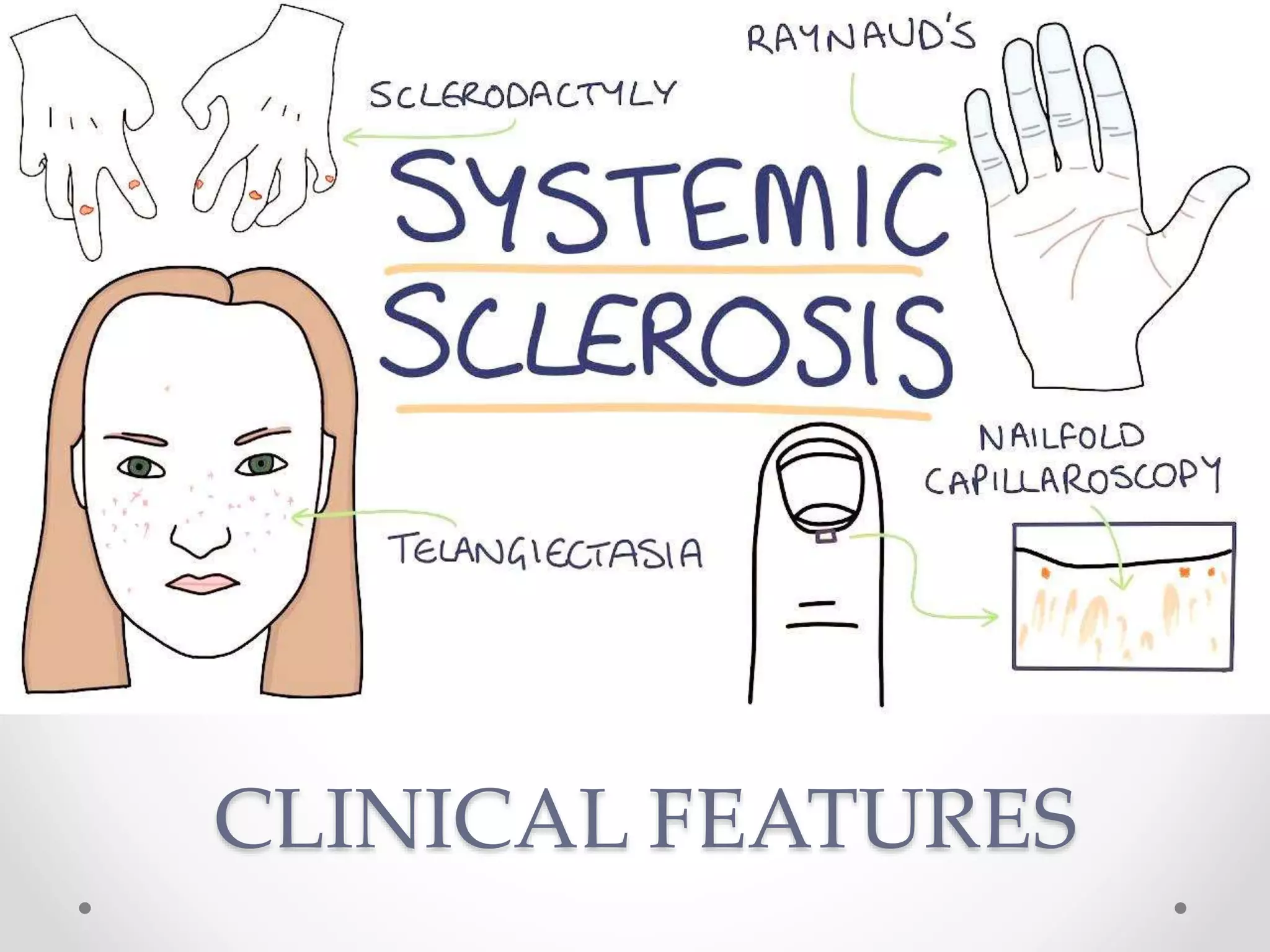 Systemic sclerosis | PPTX