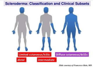 Systemic sclerosis | PPTX