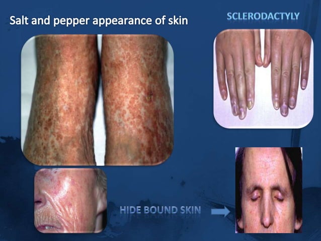 Systemic sclerosis..scleroderma