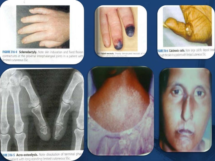 Systemic sclerosis..scleroderma