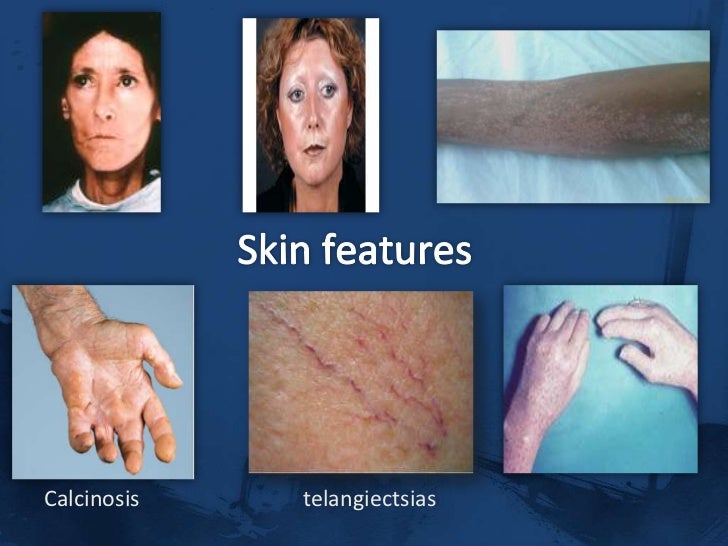 Systemic sclerosis..scleroderma